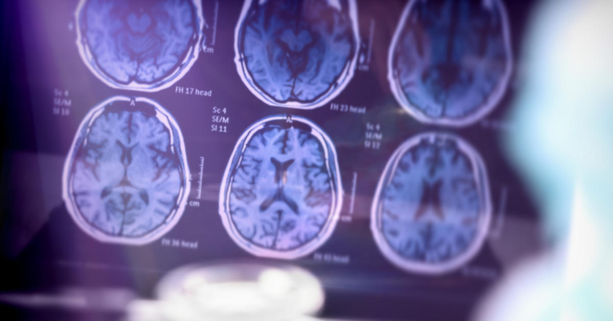 When Should You Worry About Your Memory? | UKNow