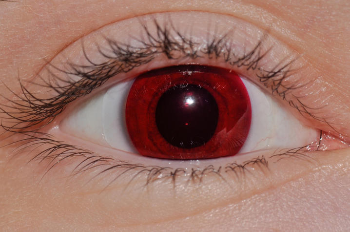 Rare Eye Conditions